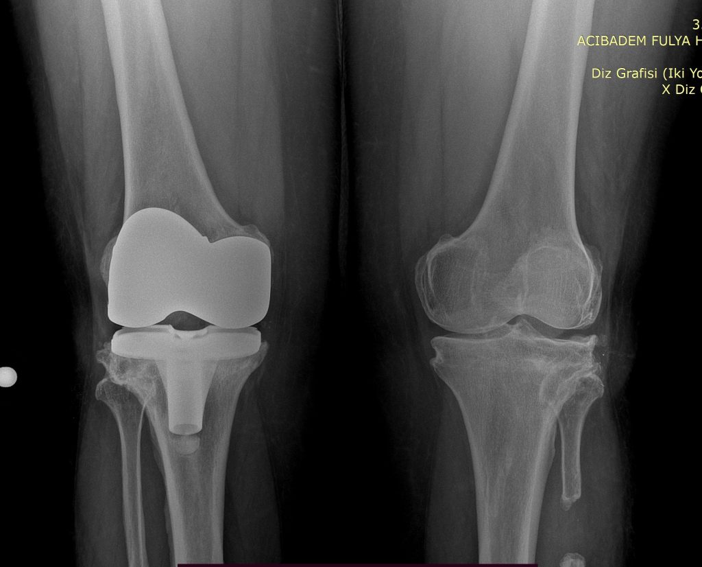 Total Diz Protezi | Prof. Dr. Erdem Bagatur
